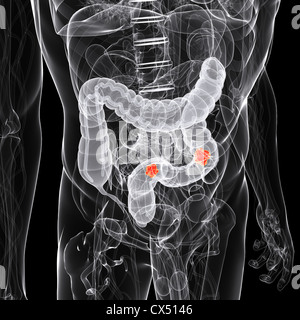 Colon cancer, illustration Stock Photo - Alamy