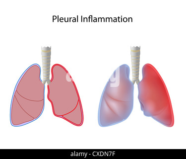 Human Pleurisy Lung Inflammation Pain Stock Photo - Alamy