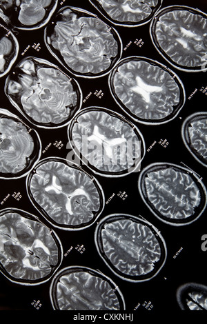 Computed tomography, CT scan of the head of a young woman who has ...