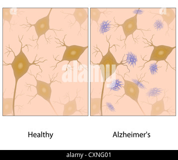 Alzheimer's disease. Illustration of amyloid plaques amongst neurons and neurofibrillary tangles ...