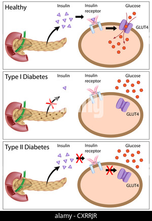 Medical diagram of Type 1 diabetes Stock Photo - Alamy