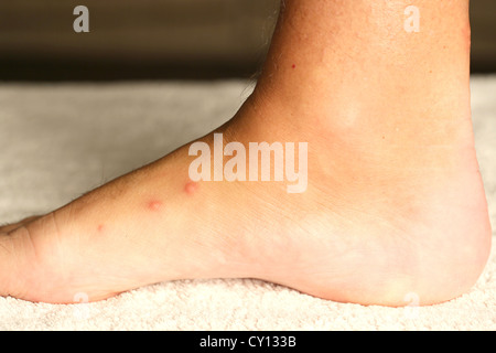 Bed bug bites on a man's foot Stock Photo - Alamy