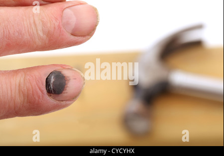 Finger Nail Hurt With Hammer. Hand Injury Stock Photo - Alamy