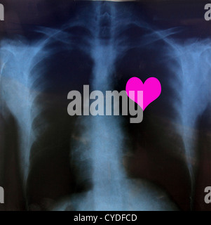 red heart with aorta and coronary arteries Stock Photo - Alamy