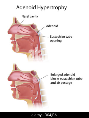 Adenoids - Ear Stock Photo: 74036134 - Alamy