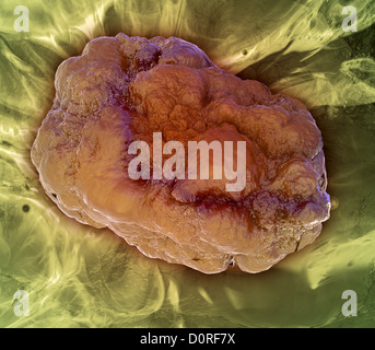 MALIGNANT TUMOR OF THE SKIN Stock Photo - Alamy