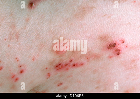 PRURITIC RASH Stock Photo - Alamy