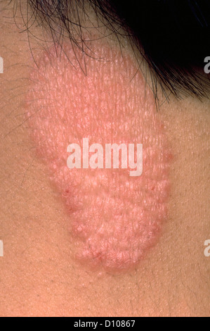 Lichen simplex chronicus Stock Photo - Alamy