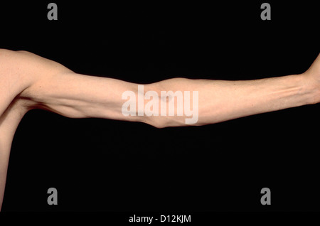 A photograph of a male with HIV associated lipodystrophy syndrome Stock ...