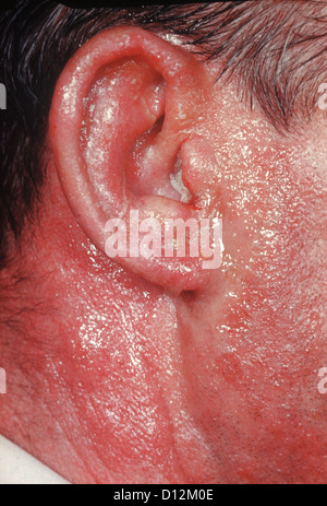 OTITIS EXTERNA Stock Photo - Alamy