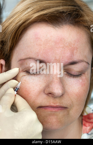 Botox injection in the eye corner, close up Stock Photo - Alamy