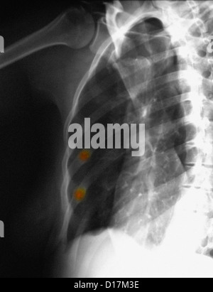 Close-up of chest x-ray diagnostic image showing lungs and rib cage ...