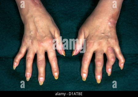 Psoriatic Arthritis with Lesions Stock Photo - Alamy