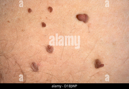 Multiple skin tags Stock Photo - Alamy