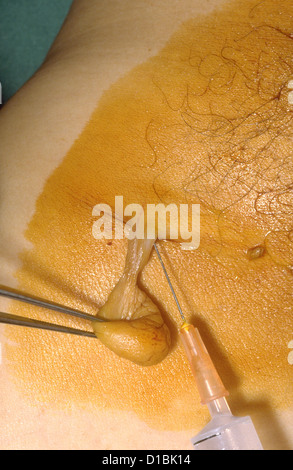 Excision of skin tag Stock Photo - Alamy