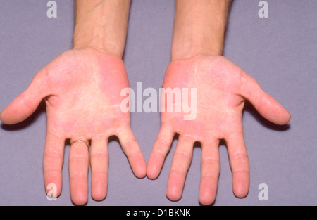Liver palms palmar erythema Stock Photo - Alamy