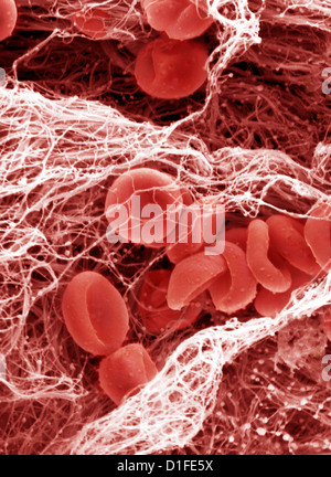 Blood clot, scanning electron micrograph (SEM). Red blood cells ...
