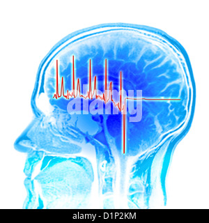 Computer artwork of an ECG (electrocardiogram) trace from an unhealthy ...