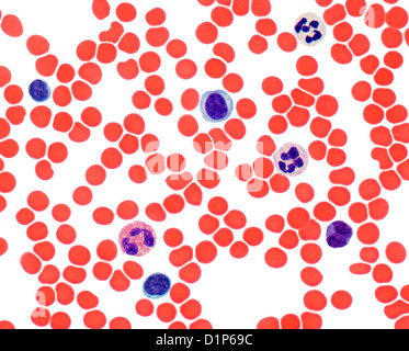 Light micrograph of a normal blood smear showing platelets, a leukocyte ...