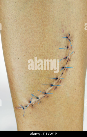 stitches on a male leg Stock Photo - Alamy