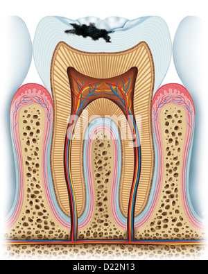 A diseased human tooth in the gum, illustrating a medico-dental concept ...