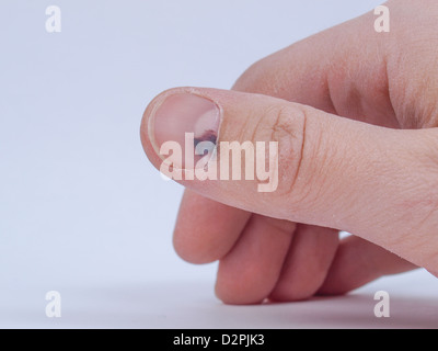 Subungual hematoma - collection of blood underneath fingernail (black ...