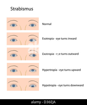 strabismus defect Esotropia, Exotropia, Hypertropia, Hypotropia Stock ...