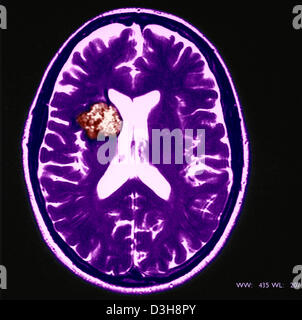CEREBRAL CAVERNOUS ANGIOMA Stock Photo - Alamy
