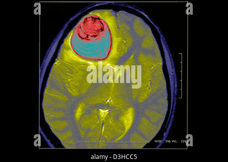 CYST IN THE BRAIN, MRI Stock Photo - Alamy