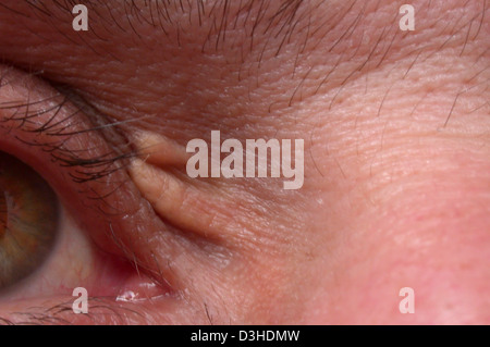 Tendon Xanthomata Rated Medicine