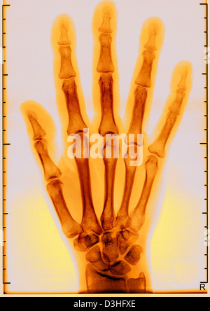 CHILD HAND, X-RAY Stock Photo - Alamy