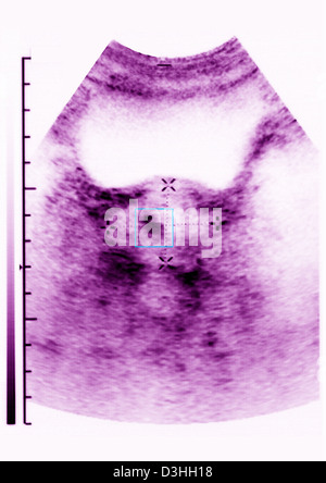 PROSTATIC CALCULUS, SONOGRAM Stock Photo - Alamy
