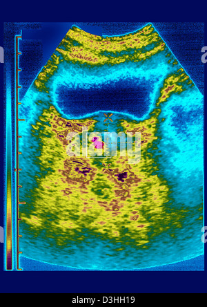 PROSTATIC CALCULUS, SONOGRAM Stock Photo - Alamy