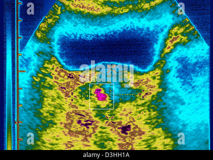 PROSTATIC CALCULUS, SONOGRAM Stock Photo - Alamy