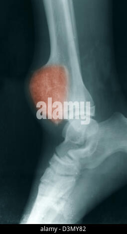X-ray showing a tumor of the distal tibia Stock Photo - Alamy