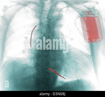Chest x-ray showing an implanted defibrillator Stock Photo - Alamy