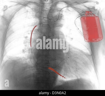X-ray of chest with defibrillator Stock Photo - Alamy
