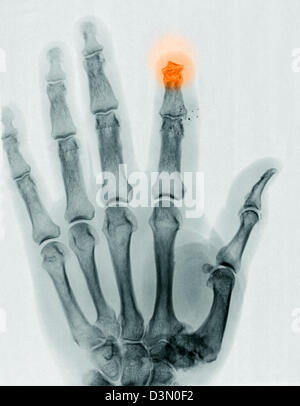 Hand x-ray of an adult man showing the amputation of the tip of the ...