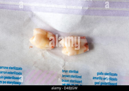 Two clean extracted wisdom teeth, not fully developed Stock Photo - Alamy