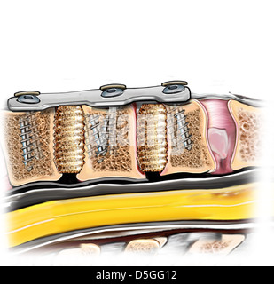 Spine bone fusion with fibular allograft, caspar pin distractor Stock ...