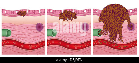 Stages and evolution of a melanoma in the skin Stock Photo - Alamy