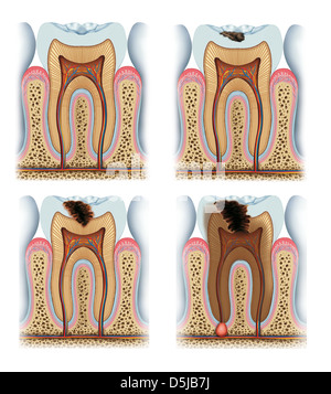 Tooth bacterial infection and teeth decay disease as an unhealthy molar ...