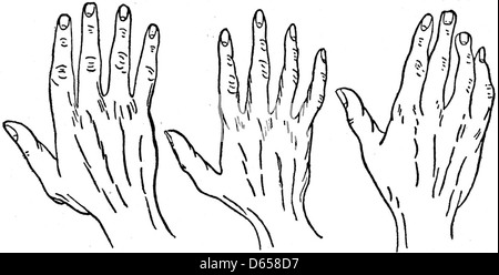A hand palmistry illustration from Cheiro, showcasing palm reading ...