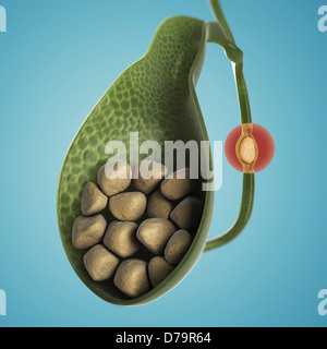 Illustration of Human gallbladder and gallstones anatomy Stock Vector ...