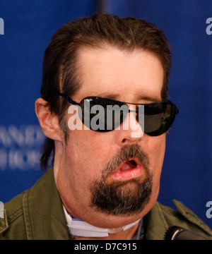 Dallas Wiens face transplant recipient, of Fort Worth, Texas, at a news ...