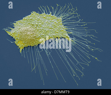 Bone cancer cell. Coloured scanning electron micrograph of an ...