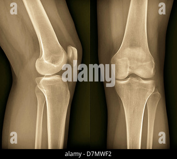 Normal knee, X-ray Stock Photo - Alamy