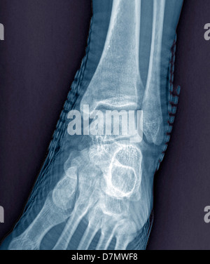 Normal radiography, xray or x-ray of the foot and ankle joint in ...