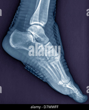 Normal ankle joint, X-ray Stock Photo - Alamy