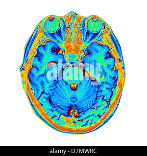 Human brain, coloured axial magnetic resonance imaging (MRI) scan. This view shows the brain's ...